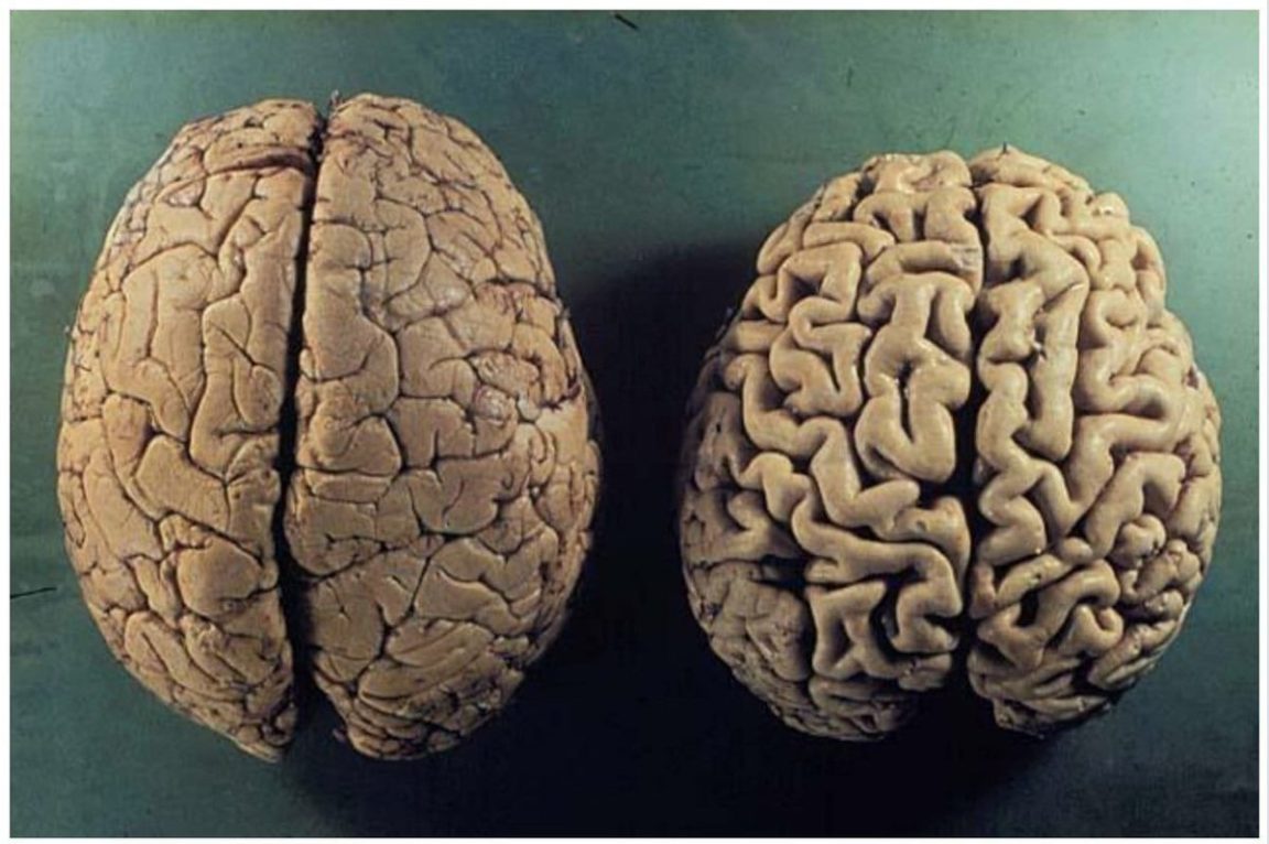 Your Brain is Under Attack—Here’s How to Heal and Protect It Before It ...